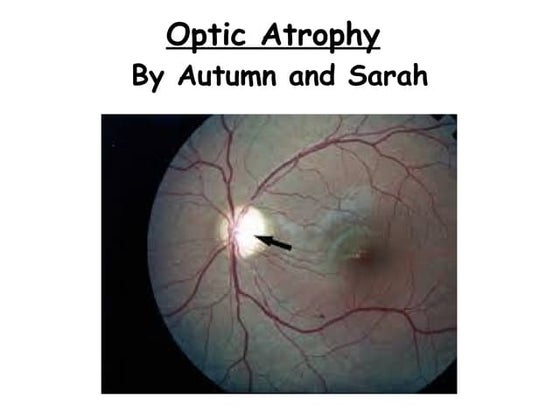 Approach to a pale optic disc | PPTX | Blood Disorders | Diseases and ...