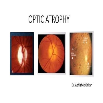 Optic atrophy | PPTX