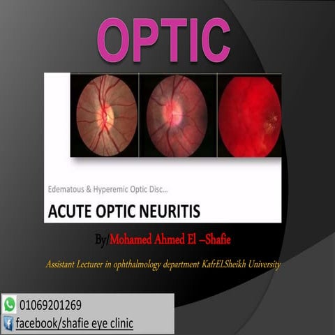 Optic nerve optic neuritis Clinical round | PPTX