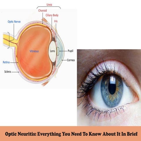 Vision Problems in Multiple Sclerosis | PPTX
