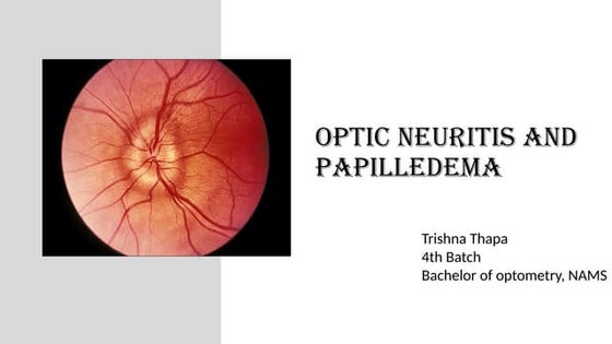 Papilledema vs papillitis with notes timothy zagada | PPT