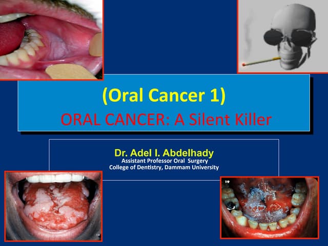 Oral Cancer Ppt