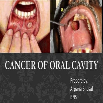 Oral Cancer | PPTX