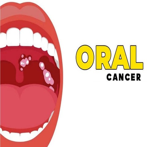 Oral Cancer- pathophysiology, TNM classification | PPTX