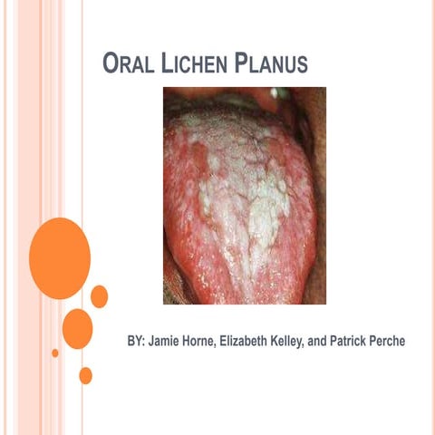 Oral lichen planus | PPTX
