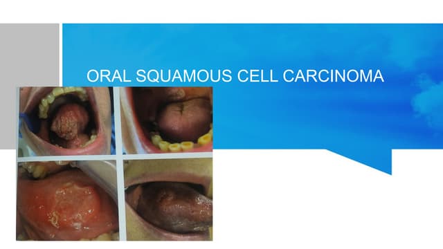 Normal Anatomy of Buccal mucosa and cancer | PPTX