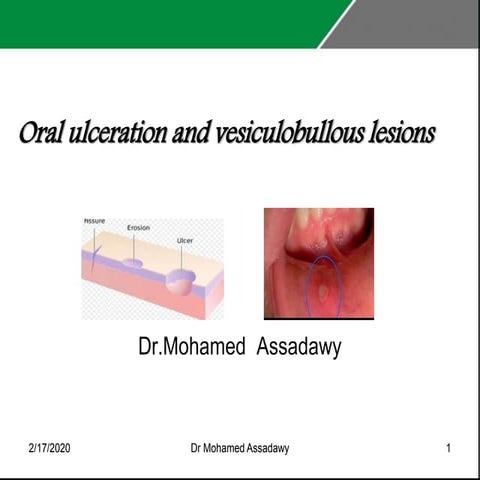 Oral ulceration Dr mohamed assadawy | PPTX