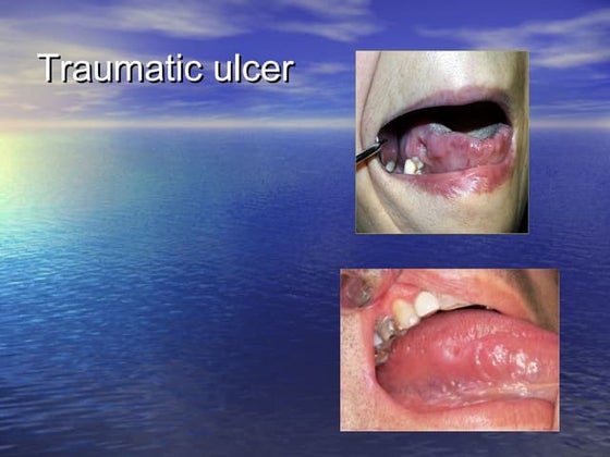 Maxillofacial infections | PPSX
