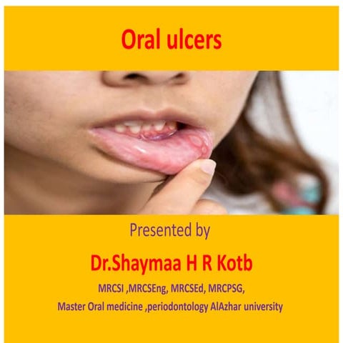 Oral ulcers.pptx