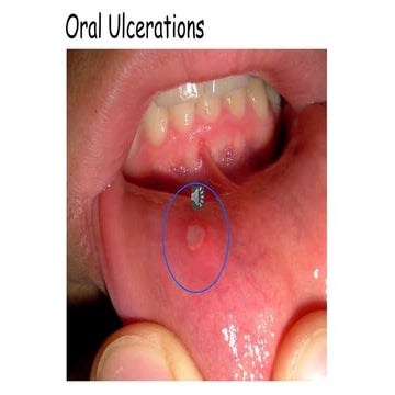 Oral pathology Flow FlowFlow Oral ulcers.pptx