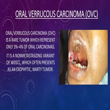 Verrucous Carcinoma Oral Cavity Benign And Malignant Tumours Of Oral