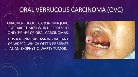 Verruocus Carcinoma - Clinical and histopathological features | PPT