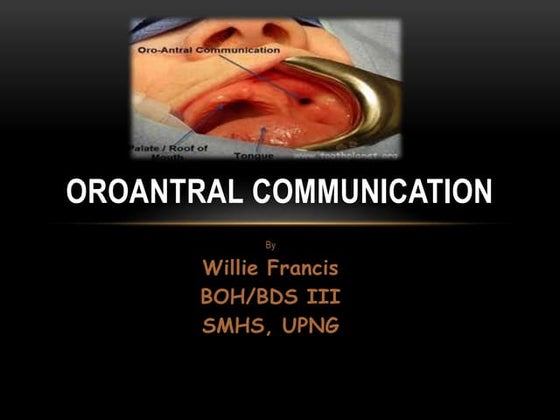 Oroantral communication and oroantral fistula | PPT