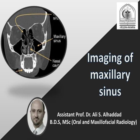 radiology of Maxillary sinus | PPT