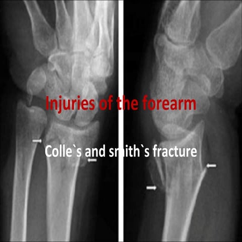 Colles fracture | PPTX