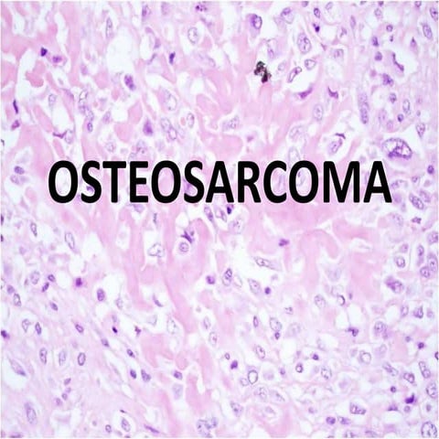 Osteosarcoma: A Detailed Review | PPTX