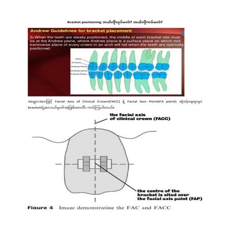 Orthodontic bracket positioning by dr nayaung | PDF