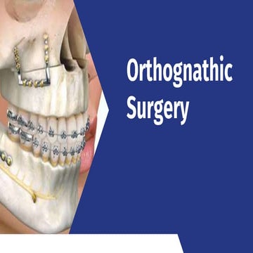 Orthognathic Surgery Ppt VSP Orthognathics