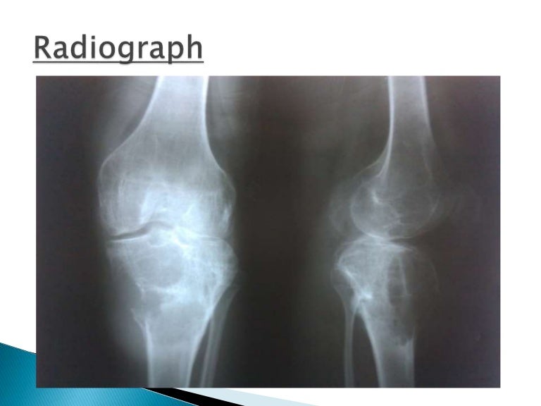Osteosarcoma Radiology Review