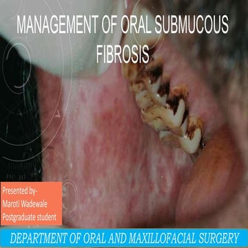 Management of oral Submucous fibrosis | PPT