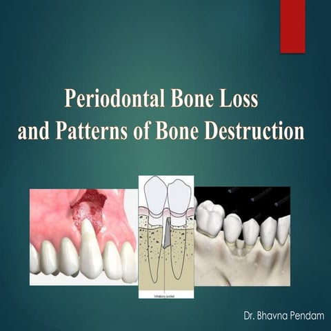 Bone loss and patterns of bone destruction | PPTX