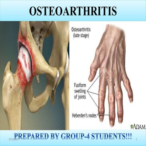 Osteoarthritis | PPTX