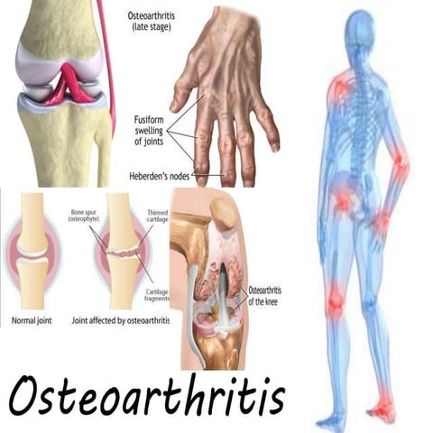 Osteoarthritis | PPT
