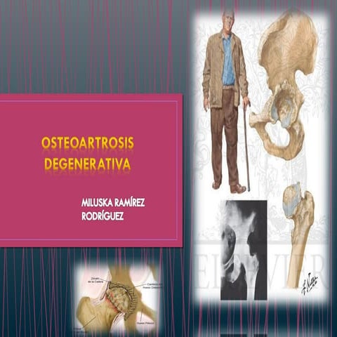 Osteoartrosis | PPT