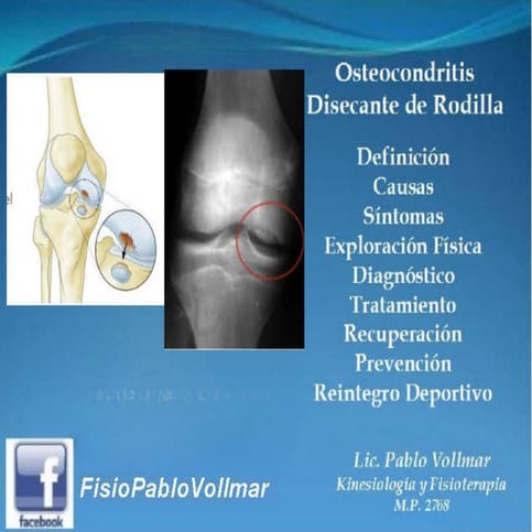 osteocondritis disecante de rodilla pablo vollmar.PDF