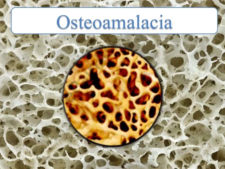 Osteomalacia