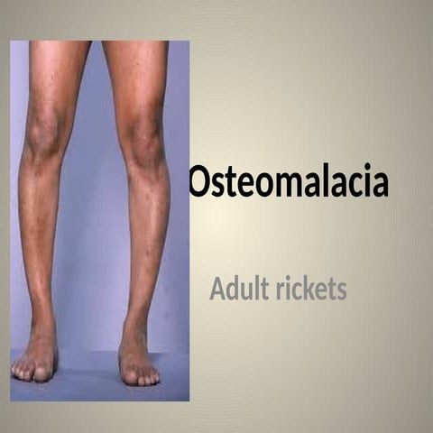 Osteomalacia In Adults Clinical Findings In Adult Patients With