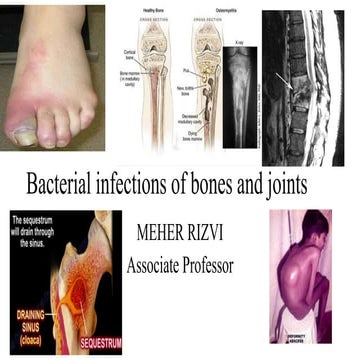 Osteomyelitis march 2018 | PPTX