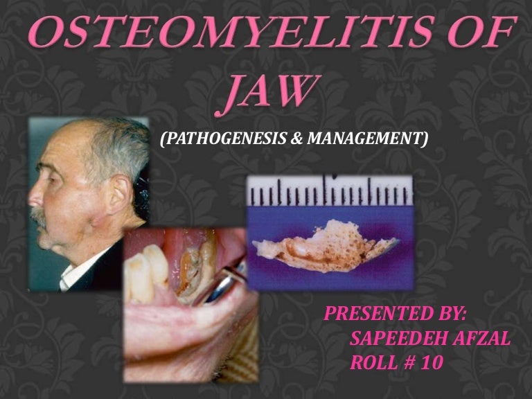 Osteomyelitis Of Jaw