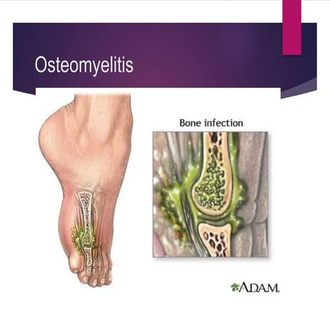 Osteomyelitis ppt | PPTX