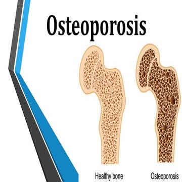 Osteoporosis clinical picture risk factors and treatment | PPTX