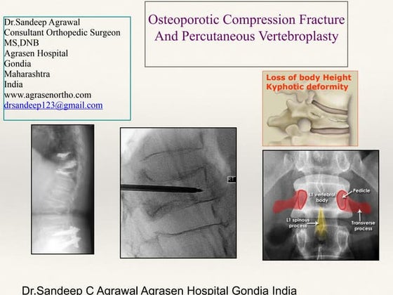 Spinal compression fractures | PPTX