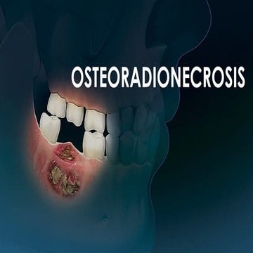 OSTEORADIONECROSIS MANAGEMENTEDITED copy.pptx