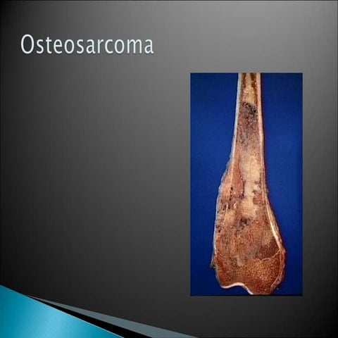 Osteosarcoma | PPT