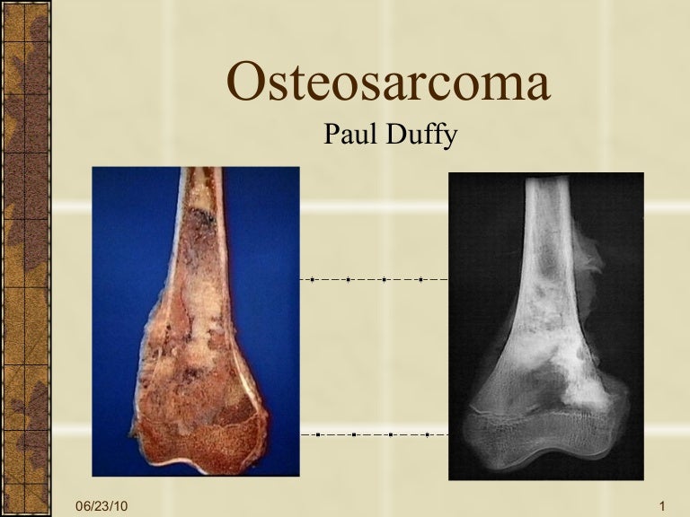 Osteosarcoma