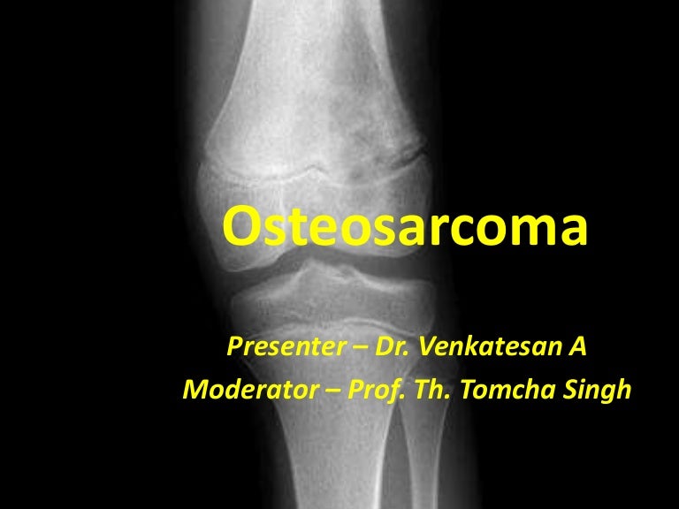 Osteosarcoma an overview