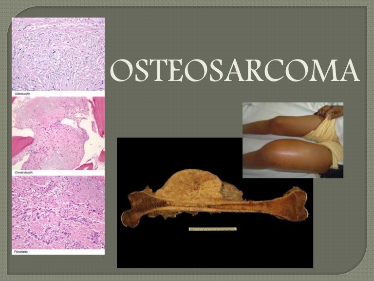 Osteosarcoma