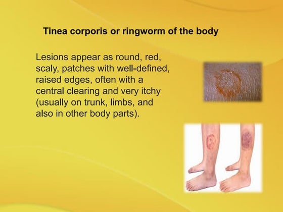 Presentation on causes and management of of ringworm infestation | PDF