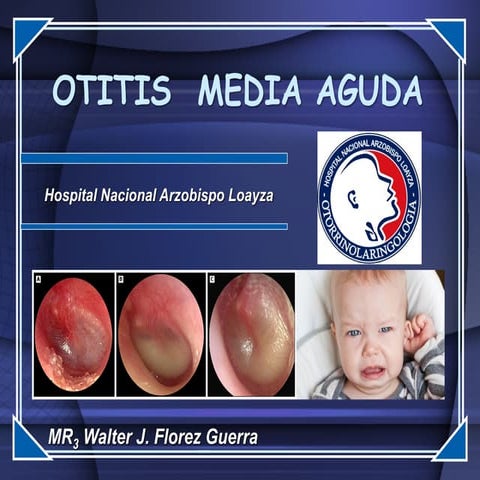 Otitis media aguda | PDF