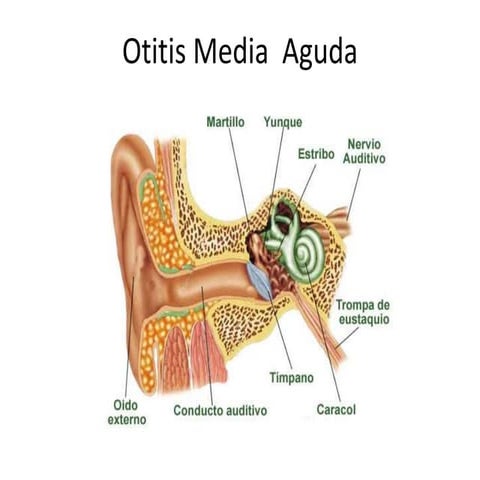 Otitis media aguda