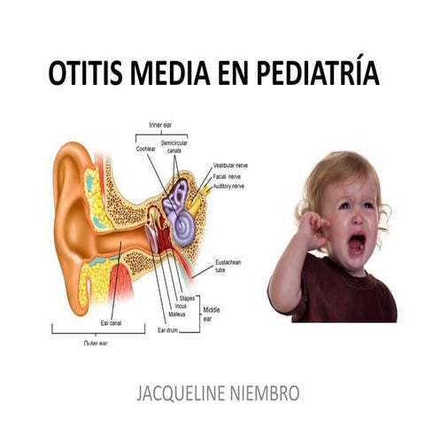 Otitis media aguda