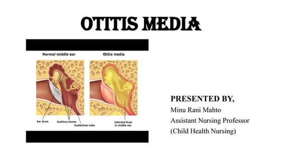 Otitis Media | PDF