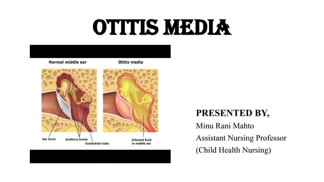 Otitis media in children | PPTX