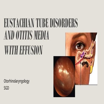Serous otitis media with effusion glue ear.pptx