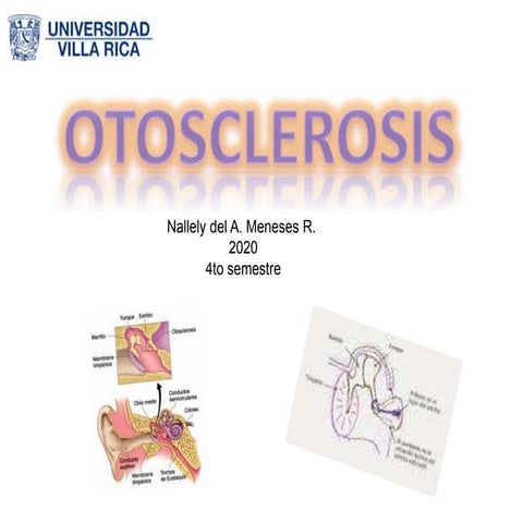 Otosclerosis Radiopaedia