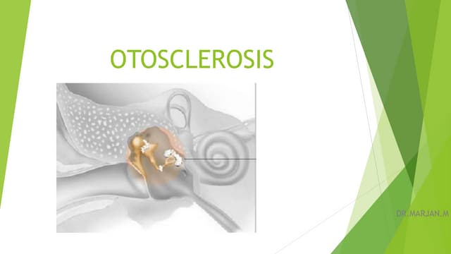 Otosclerosis | PPTX
